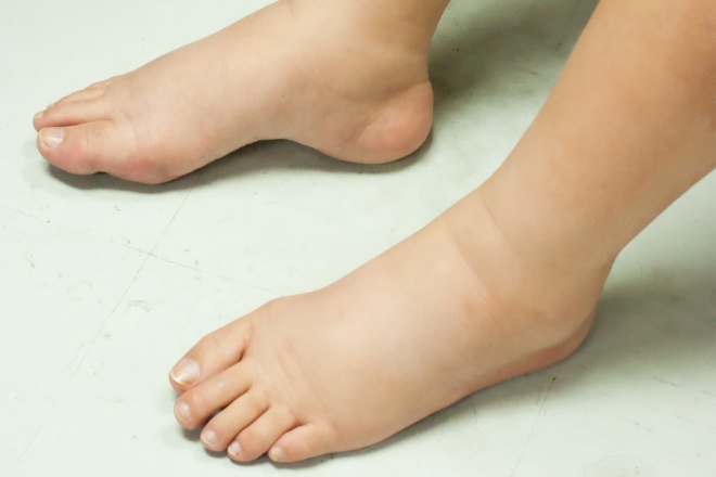 Is Swollen Feet Associated with Alcohol? | New Health Advisor